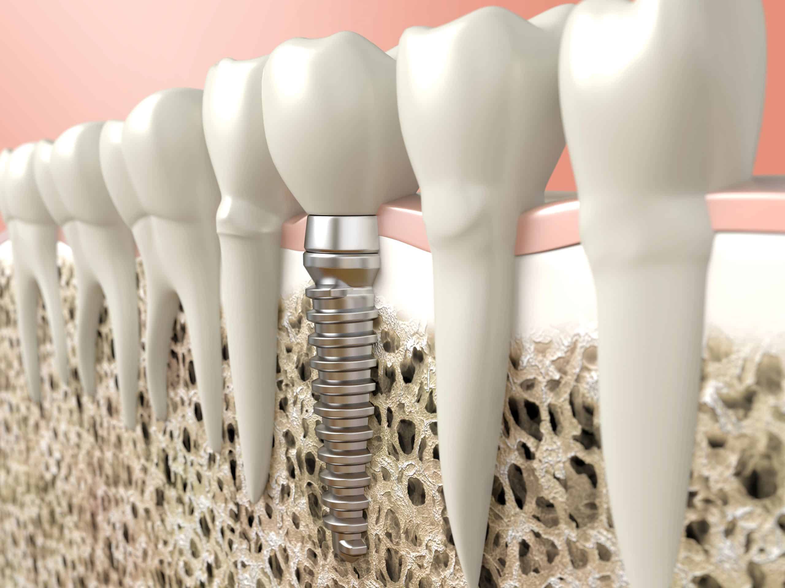 Dental Implants vs Dentures: Which Solution Suits Your Needs? | Rocky ...